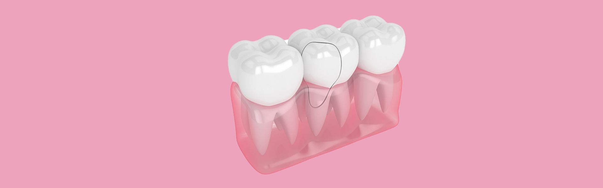 How to Relieve Pain from a Half-Broken Molar Tooth | Blog